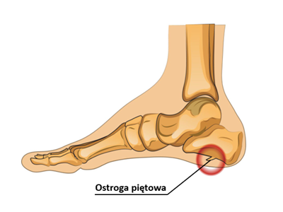 Dlaczego boli mnie stopa od spodu? Przyczyny i sposoby leczenia | Sklep ...