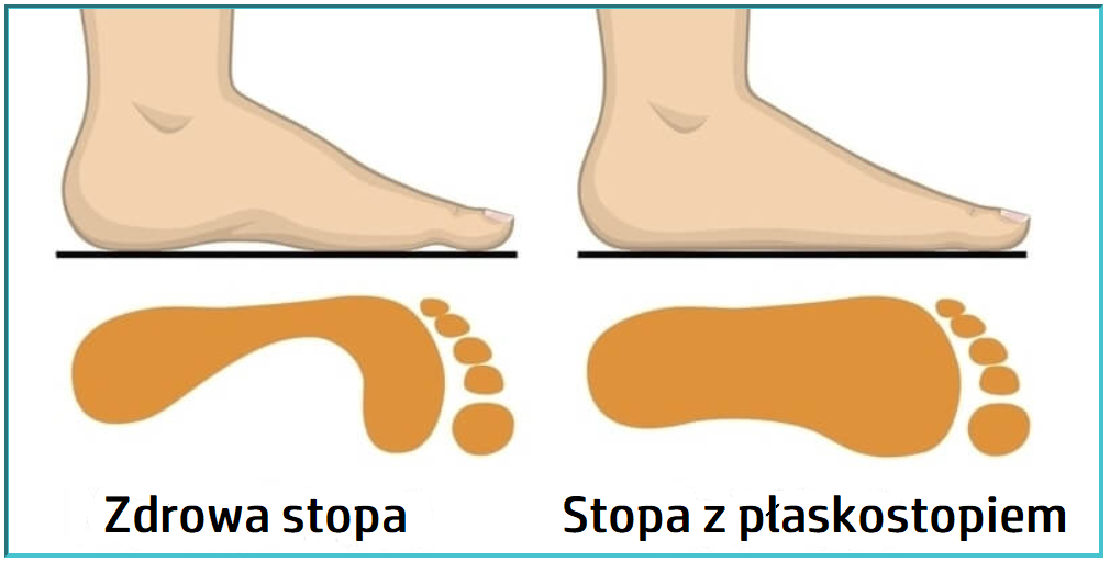 Wady stóp u dzieci - co może zaniepokoić rodziców? | Blog | Vaya Medical