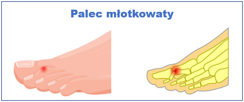 Palce młotkowate - przyczyny, ćwiczenia, leczenie - Vaya Medical