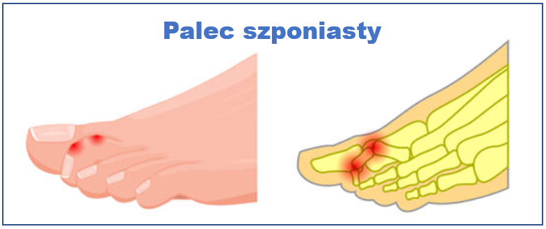 Palce młotkowate - przyczyny, ćwiczenia, leczenie - Vaya Medical