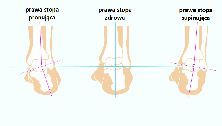 Wkładki supinujące przy koślawości i pronujące przy szpotawości stóp ...