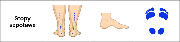 Szpotawość stóp - przyczyny, cwiczenia - Vaya Medical