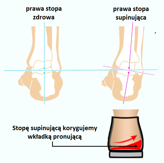 Supinacja stopy i nadmierna supinacja — jak zapobiegać bólom stóp i ...