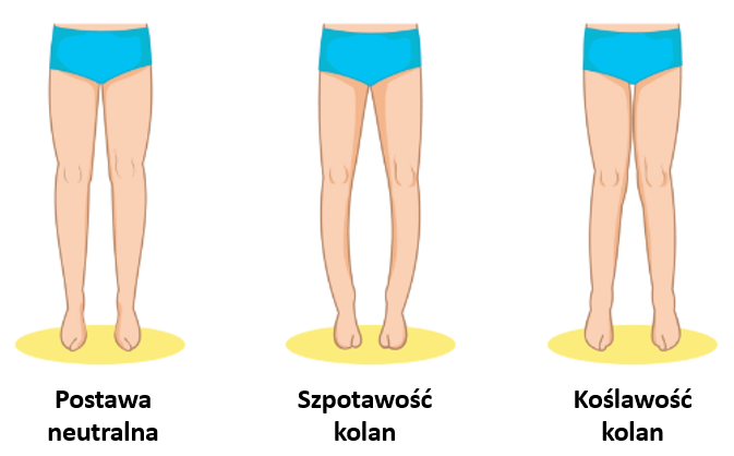 Wkładki supinujące przy koślawości i pronujące przy szpotawości stóp ...