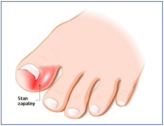 Wrastające paznokcie u nóg - przyczyny, objawy, leczenie | Vaya.com