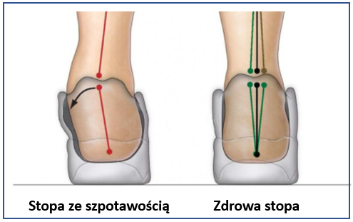 Wady stóp u dzieci - co może zaniepokoić rodziców? - Vaya Medical